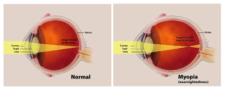 Short Sight or Myopia – What Is It And What Can You Do About It? - We ...
